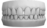 National Dentex | Aligners